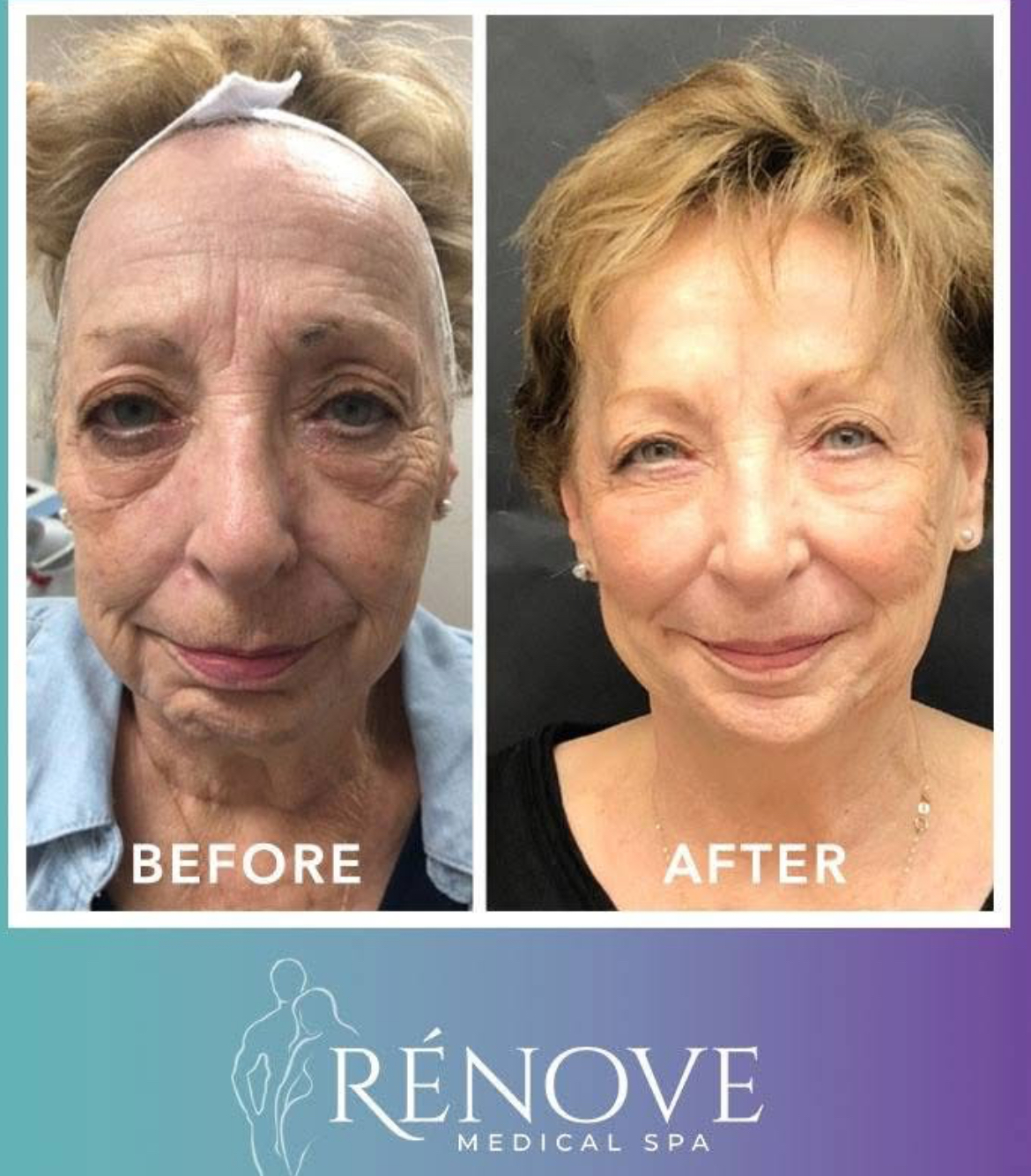 PDO Thread Lift in Kingwood | Facelift | Rénove Med Spa